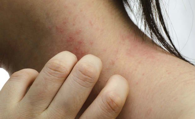 Você conhece a Dermatite de contato? – Clínica Pró-Saúde